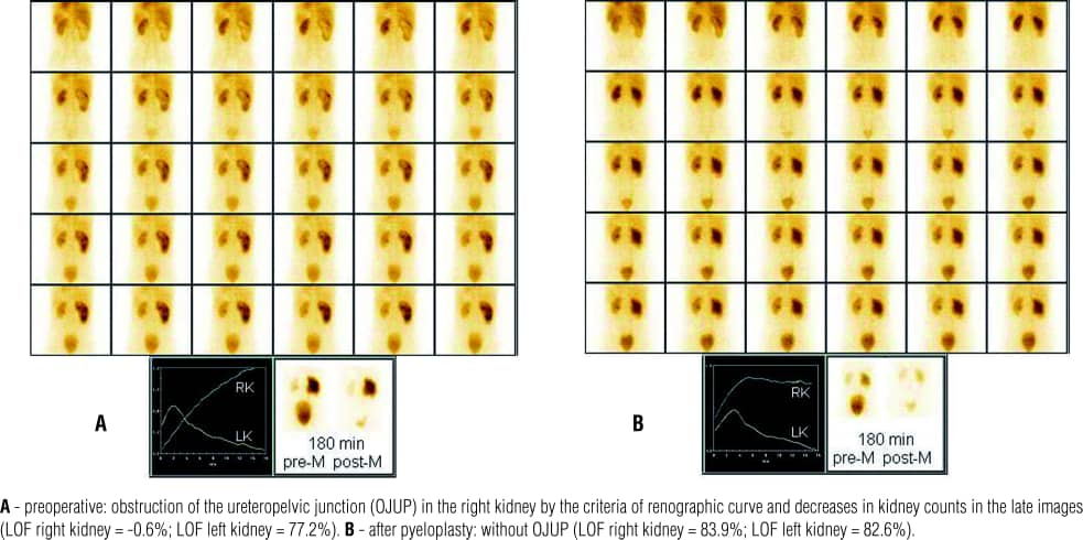 تنگی محل اتصال لگنچه کلیه به میزنای (UPJO) – دکتر عباس حسن پور